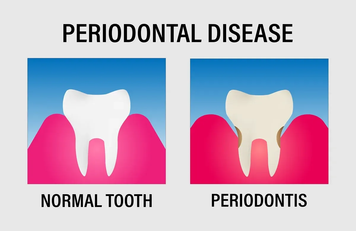 Can Advanced Periodontal Disease Be Reversed? | Noble Dental Care